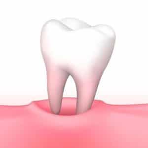 Tooth Extraction - Knoxville Oral & Maxillofacial Surgery