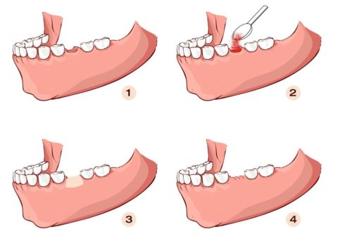 Ridge Augmentation - Knoxville Oral & Maxillofacial Surgery